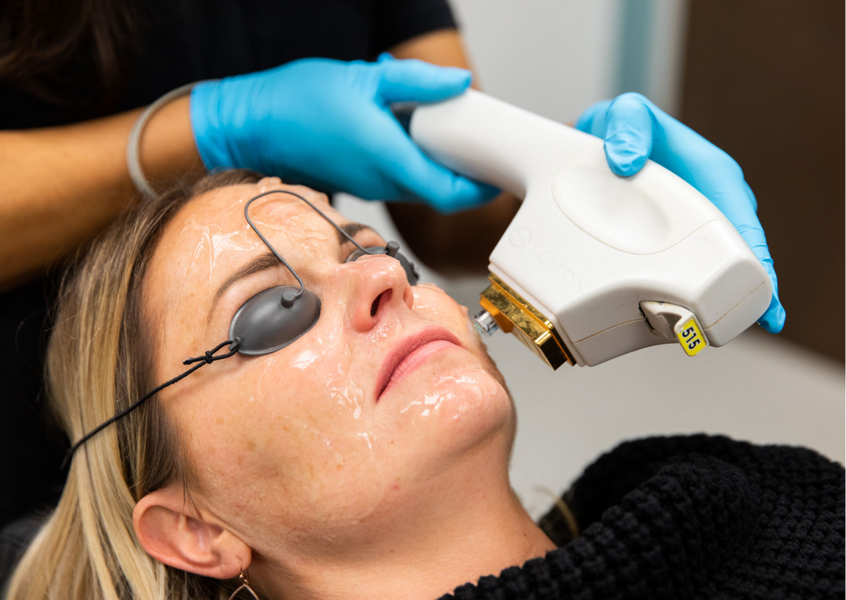 BBL® HERO™ Broadband Light Photofacial – Sanctuary Cosmetic Center